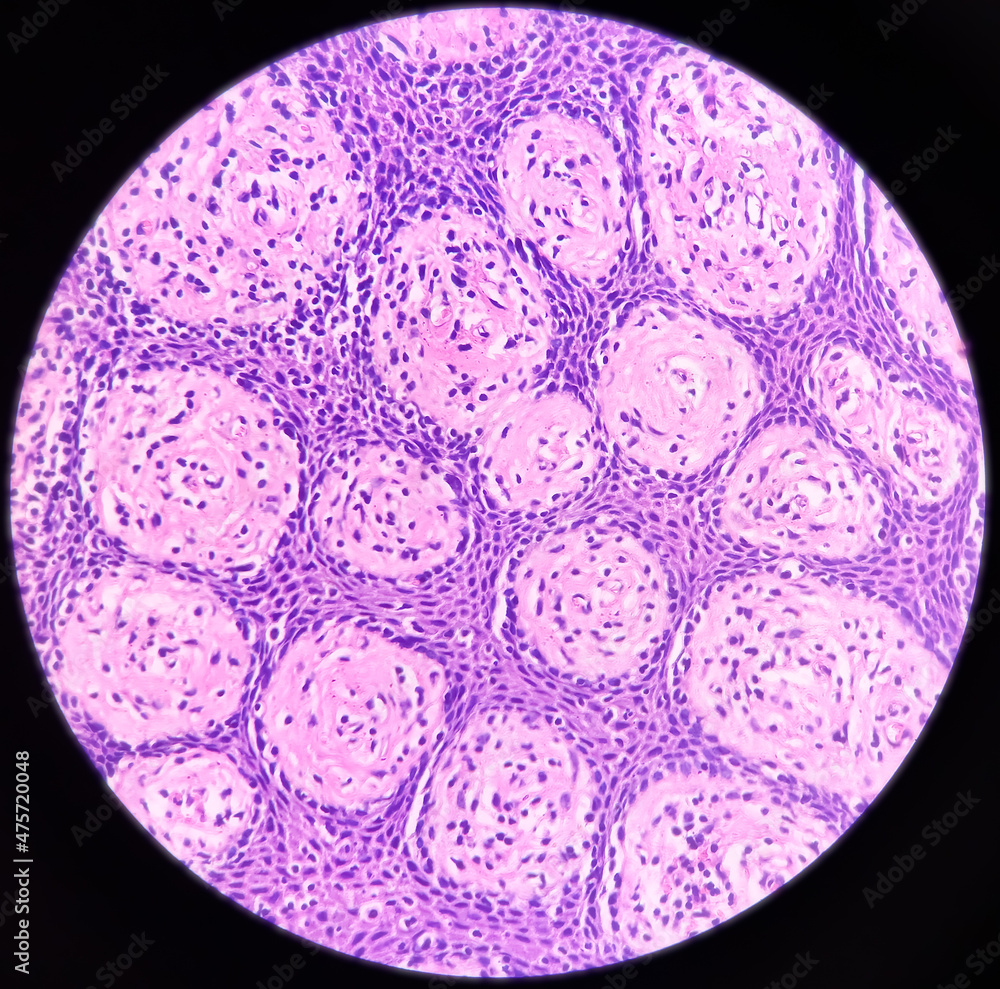 Stock-Foto „Tongue with mandible cancer, oral cancer, Invasive squamous ...