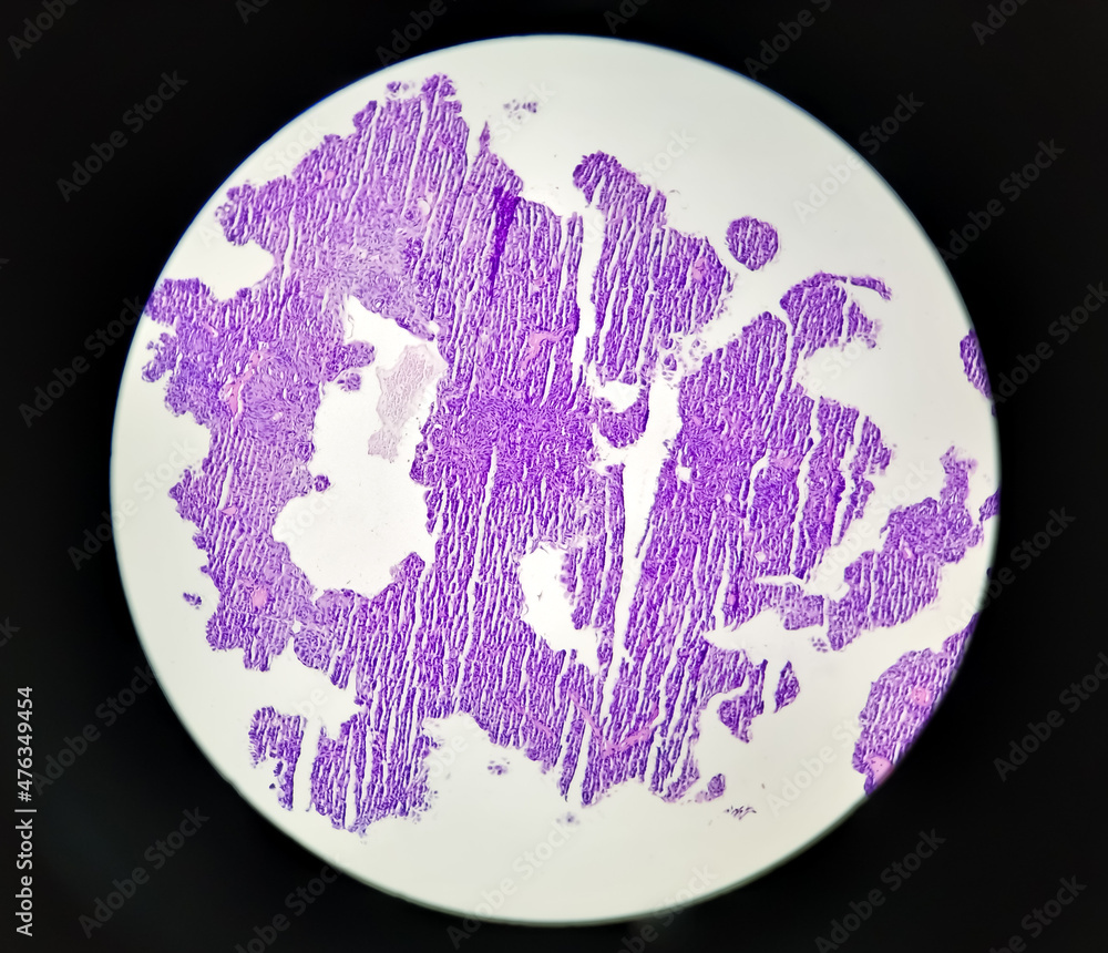 Leiomyoma, or fibroids, is a smooth muscle benign tumors, light ...