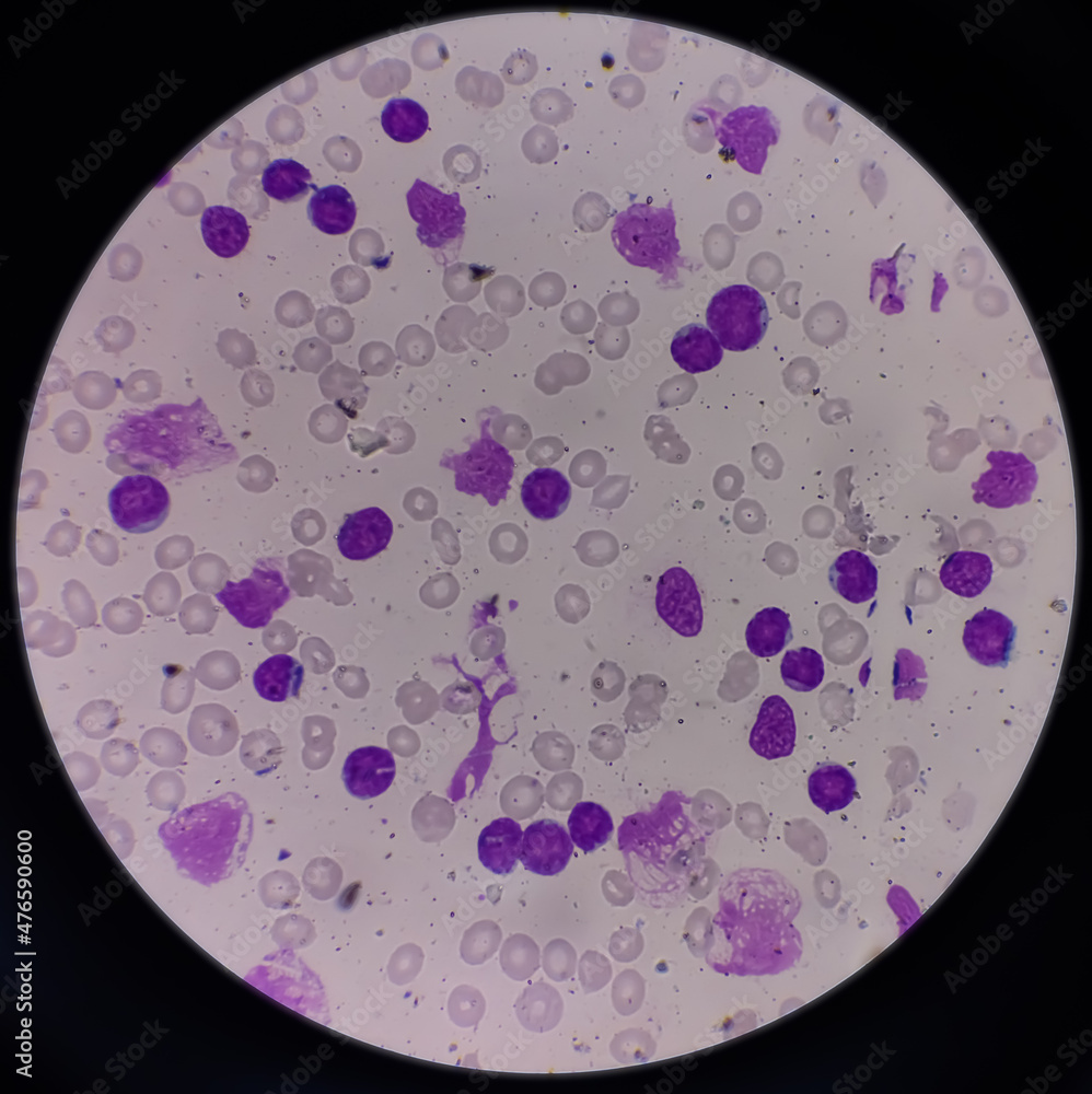 Chronic myeloid leukemia (CML) is a type of blood cancer. Microscopic ...