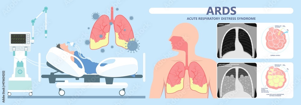 Acute respiratory distress syndrome (ARDS) a respiratory failure and ...