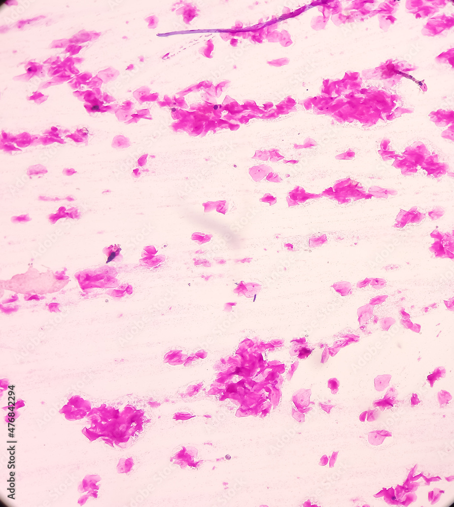High Vaginal Swab (HVS): gram stained microscopic view of epithelial ...