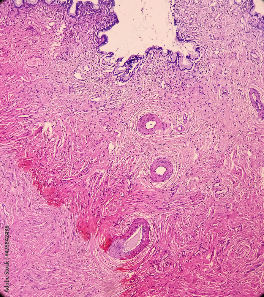 Chronic cervicitis with CIN-1, under light microscope show chronic ...
