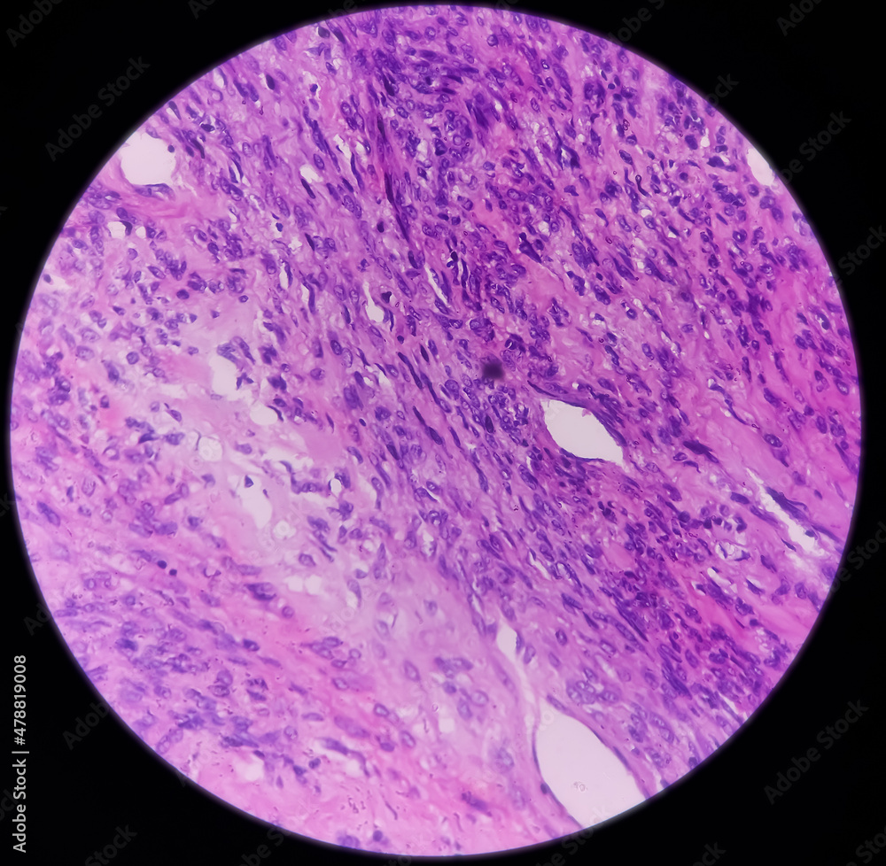 Foto de Stock Fibroid uterus leiomyoma, myoma, also known as fibroids ...