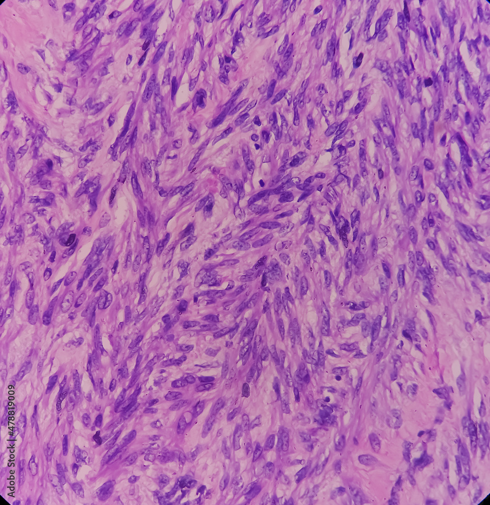 Fibroid uterus leiomyoma, myoma, also known as fibroids, benign tumor ...