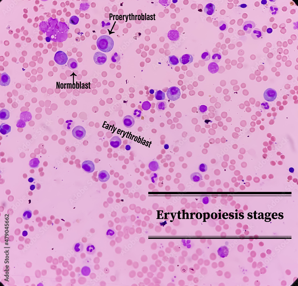Photo Stock Microscopic view of bone marrow slide, megaloblastic anemia ...
