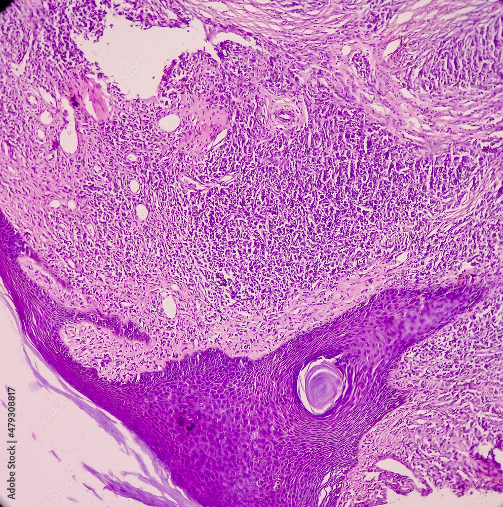 Tissue from scalp: tumors of Skin, microscopic image of a ...