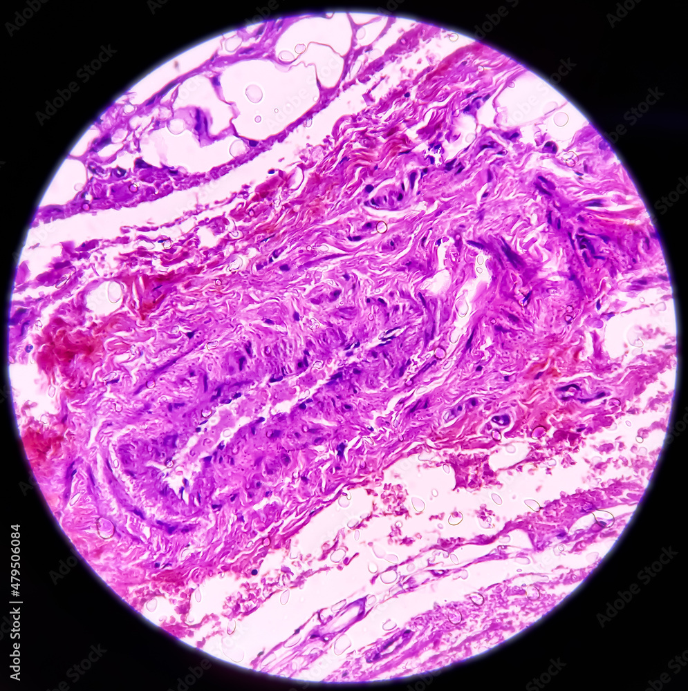 Chest wall cyst(biopsy): Epidermal inclusion cyst, commonly called ...