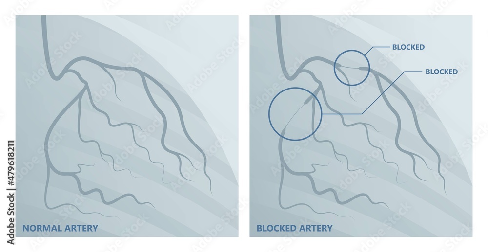 Angiography medical operation Angiogram Biopsy Angioplasty Stent ...