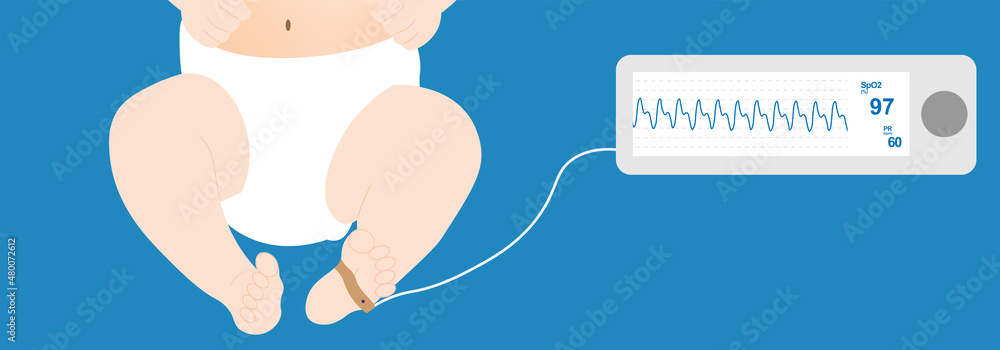 Newborn pulse oximetry monitoring. Sensor placed in the foot of a ...
