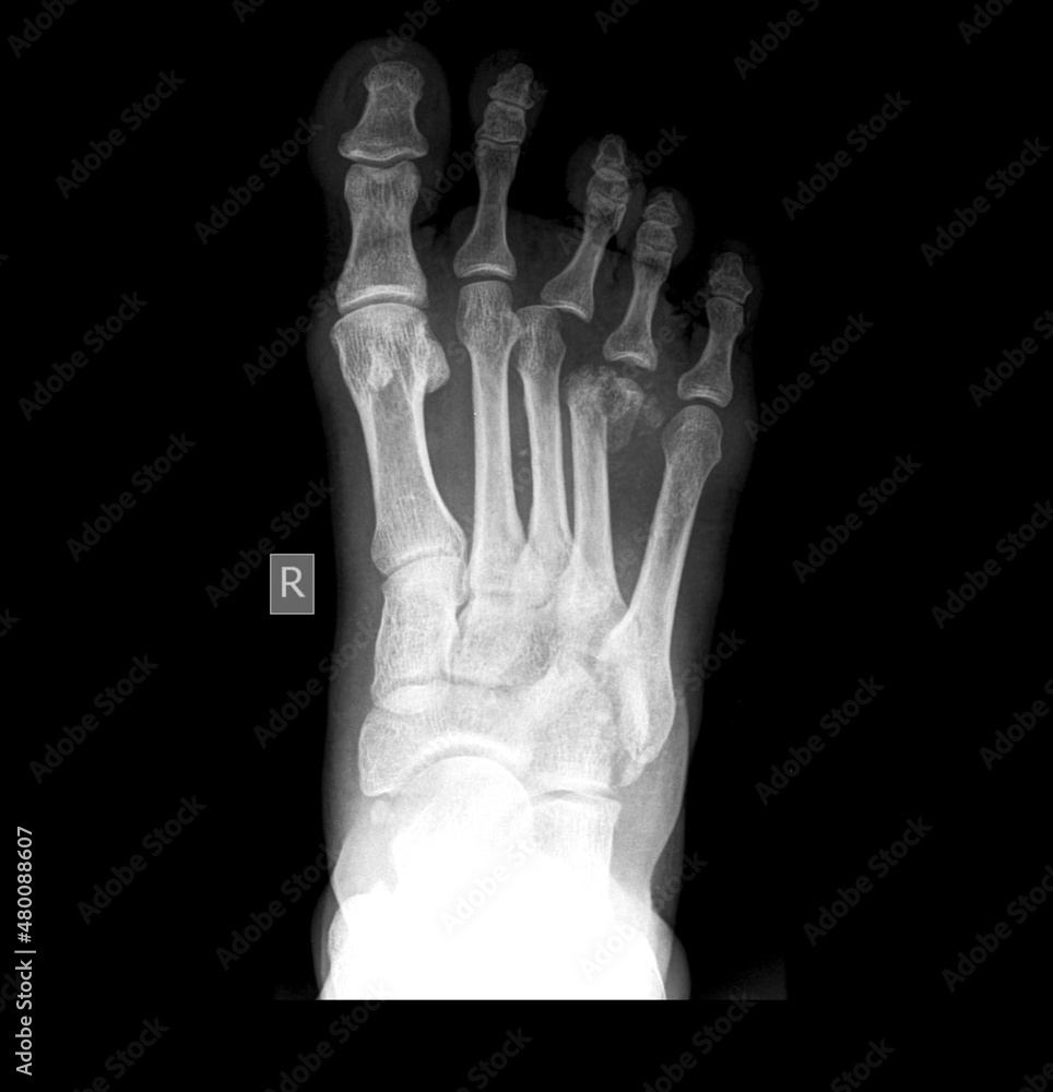 x ray image of fractures and dislocation of phalanx proximal pedis ...