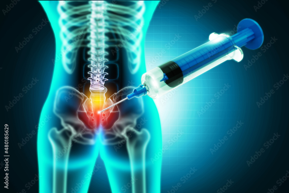 3d illustration of a lumbar spine injection Stock Illustration | Adobe ...