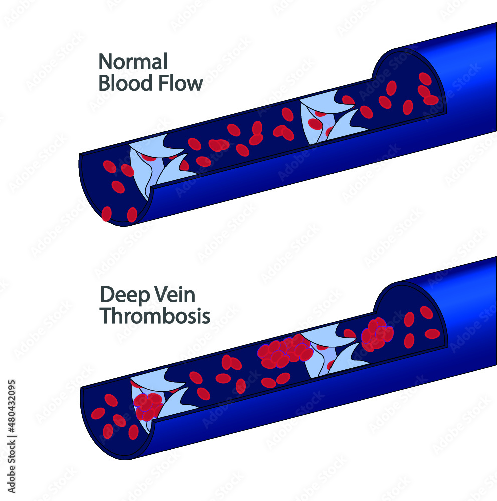 Deep Vein Thrombosis (DVT). Vein blood flow illustraion of a normal ...