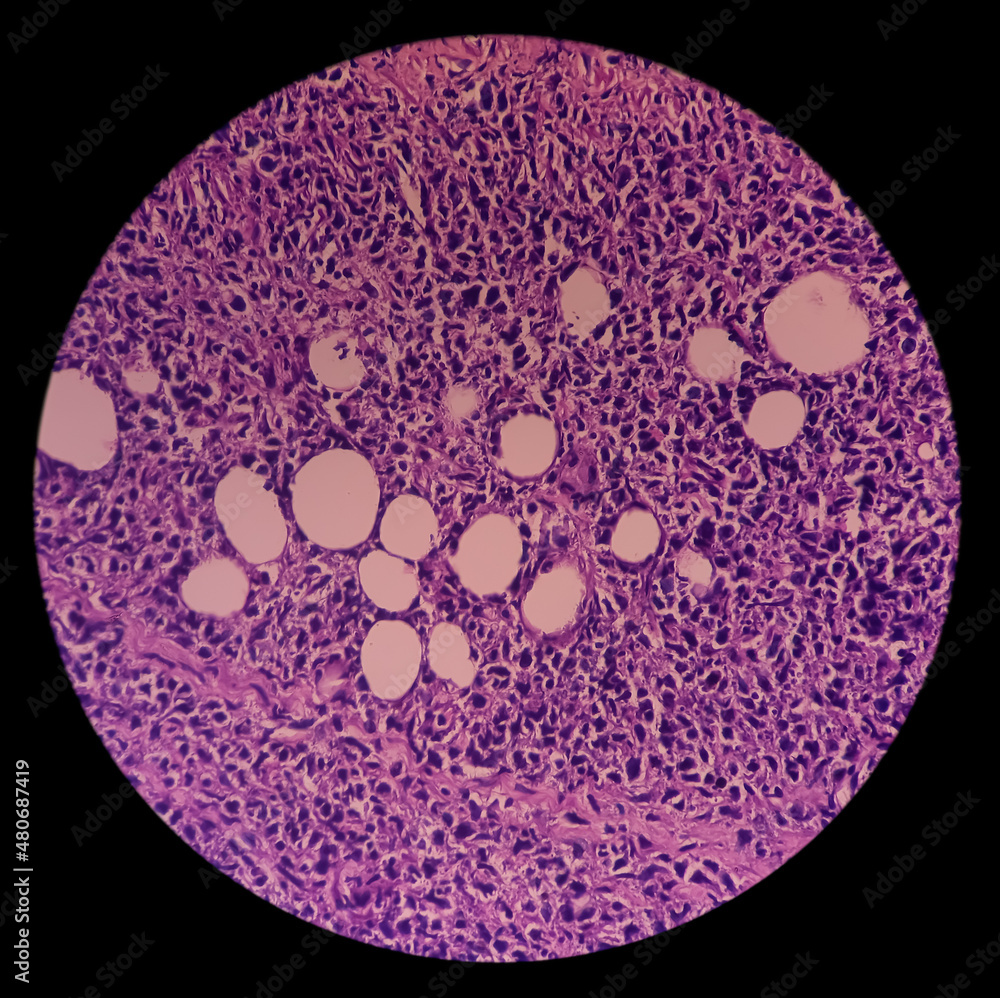 Microscopic image of Colorectal carcinoma and Amelanotic melanoma. Show ...