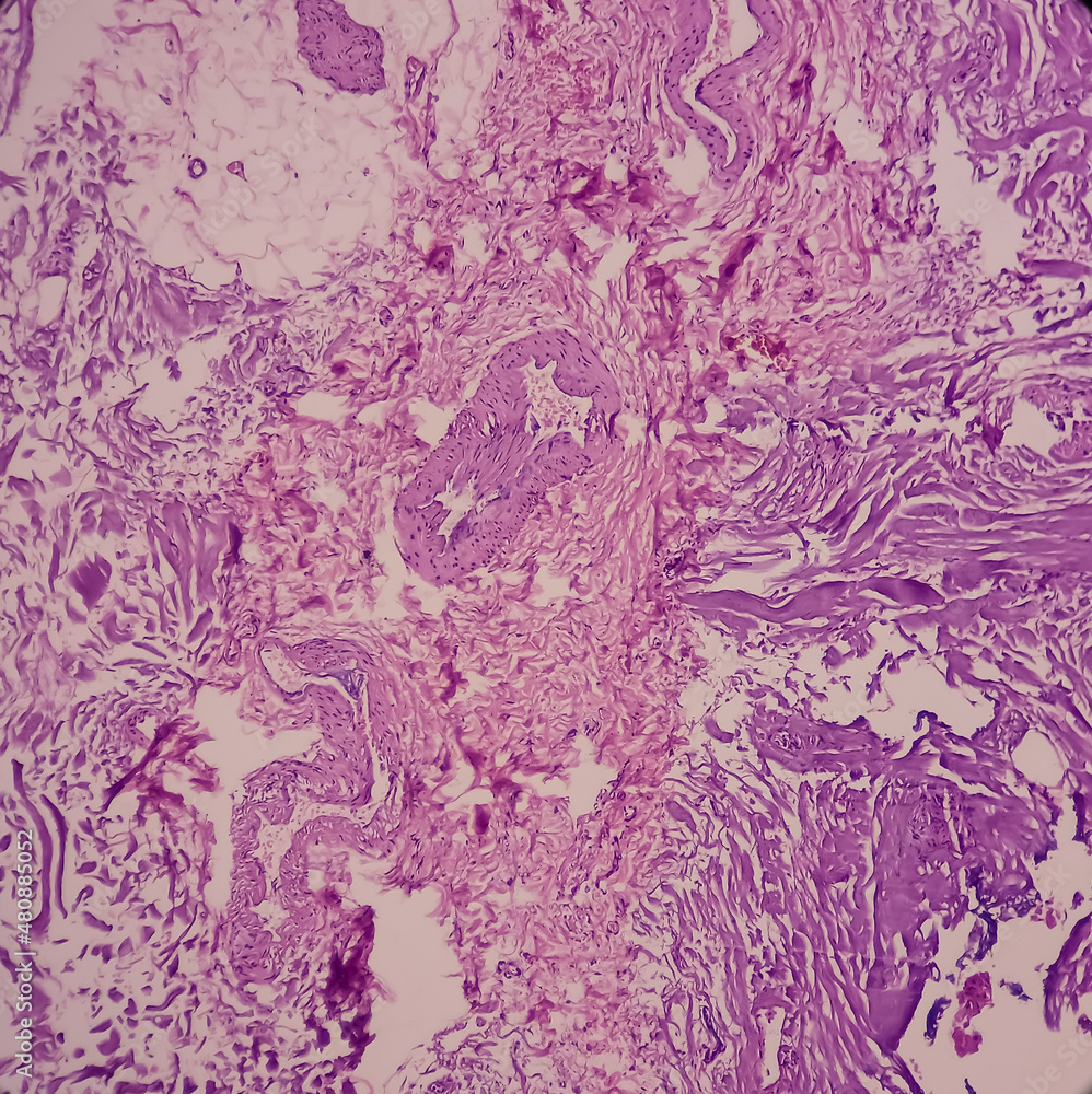 Foto de Stock Cholelithiasis of Gallbladder, microphotograph of chronic ...