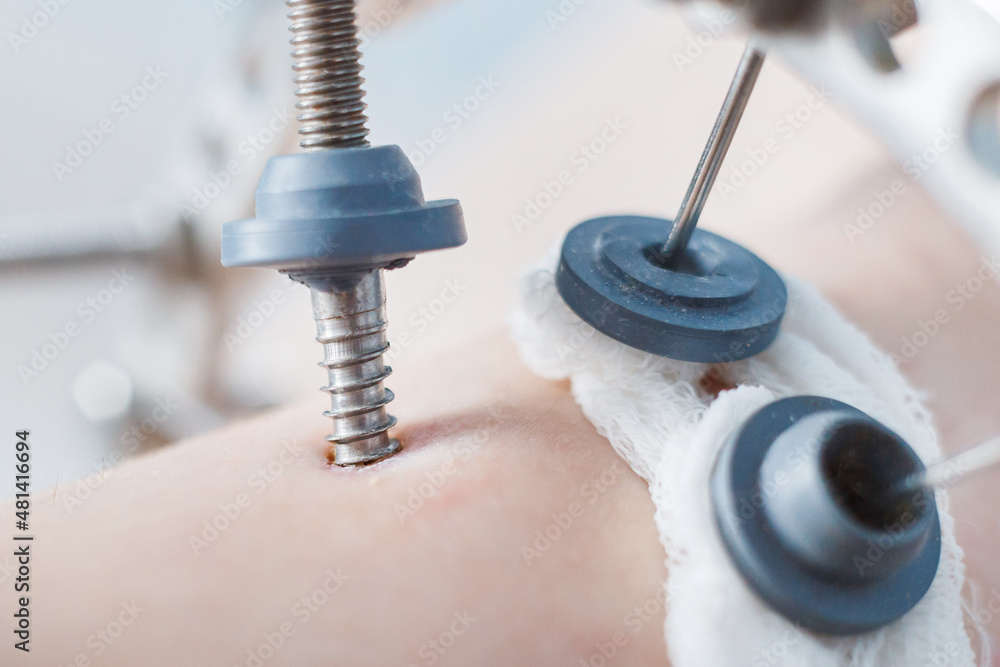 External ring fixation technique Ilizarov, in orthopedic medicine ...