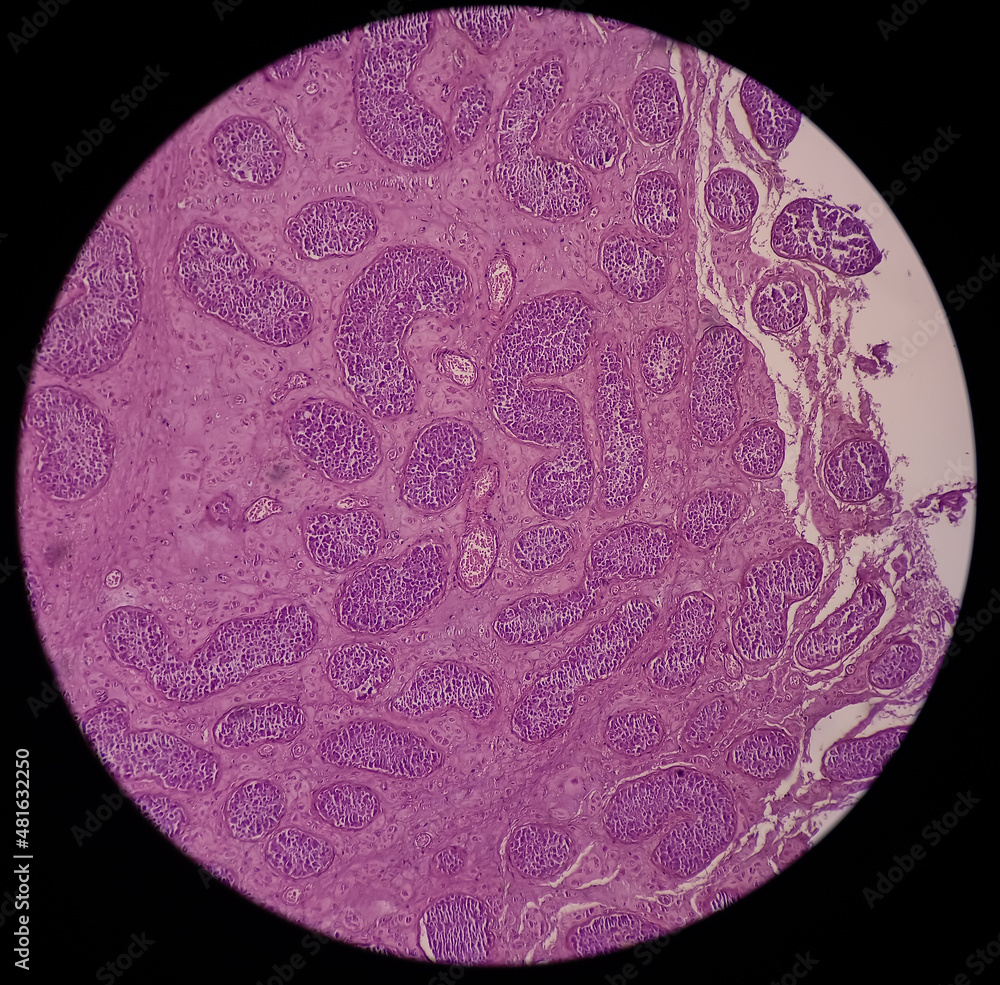 Microscopic image torsion of testicles, disease of male genital organs ...