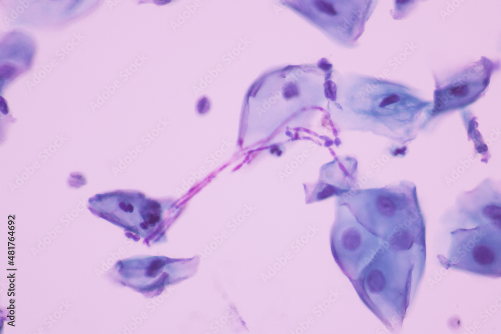 Photo Stock View in microscopic of Candidiasis, fungus infection (Yeast ...
