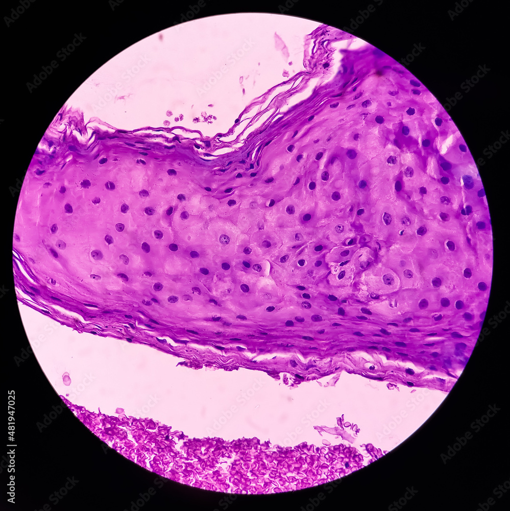 Oral mucosa carcinoma: Squamous cell carcinoma, poorly differentiated ...