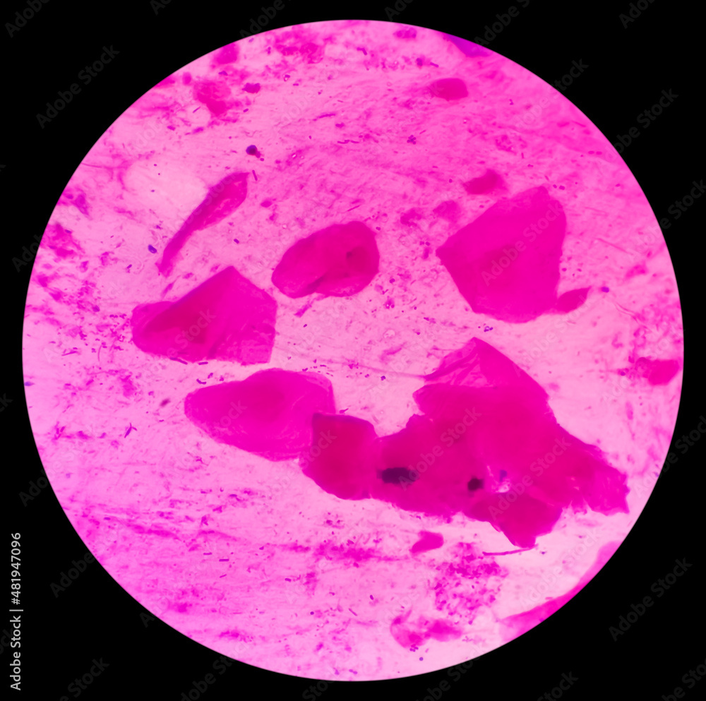 Gram stain of throat swab: Microscopic view show plenty epithelial ...