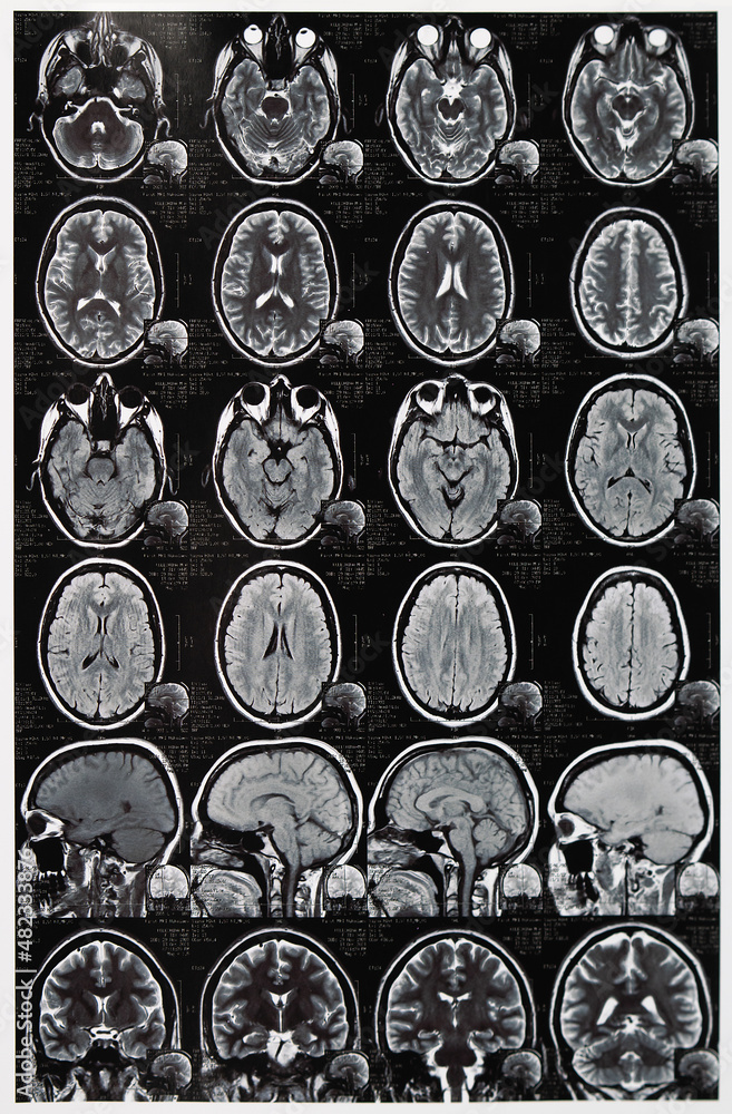 Human brain MRT scans. Computer tomography CT photos of human brain ...