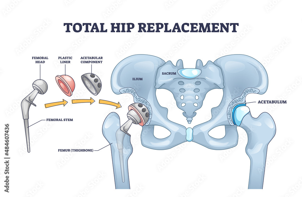 Total hip replacement surgery with anatomical acetabular prosthesis ...