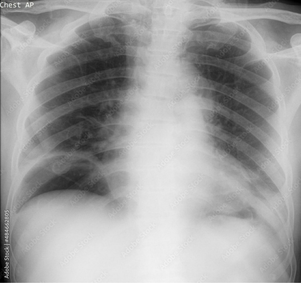 x ray image of pneumoperitoneum,subdiafragma free air,chest x ray Stock ...