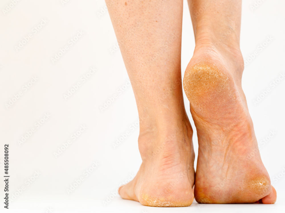 Dry skin, plantar callosity and flakes on the female heel and feet sole ...
