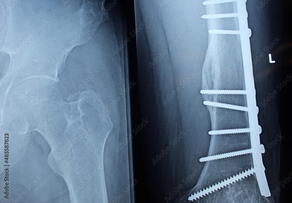 Plain X ray on the left femur that shows united mid shaft left femur ...