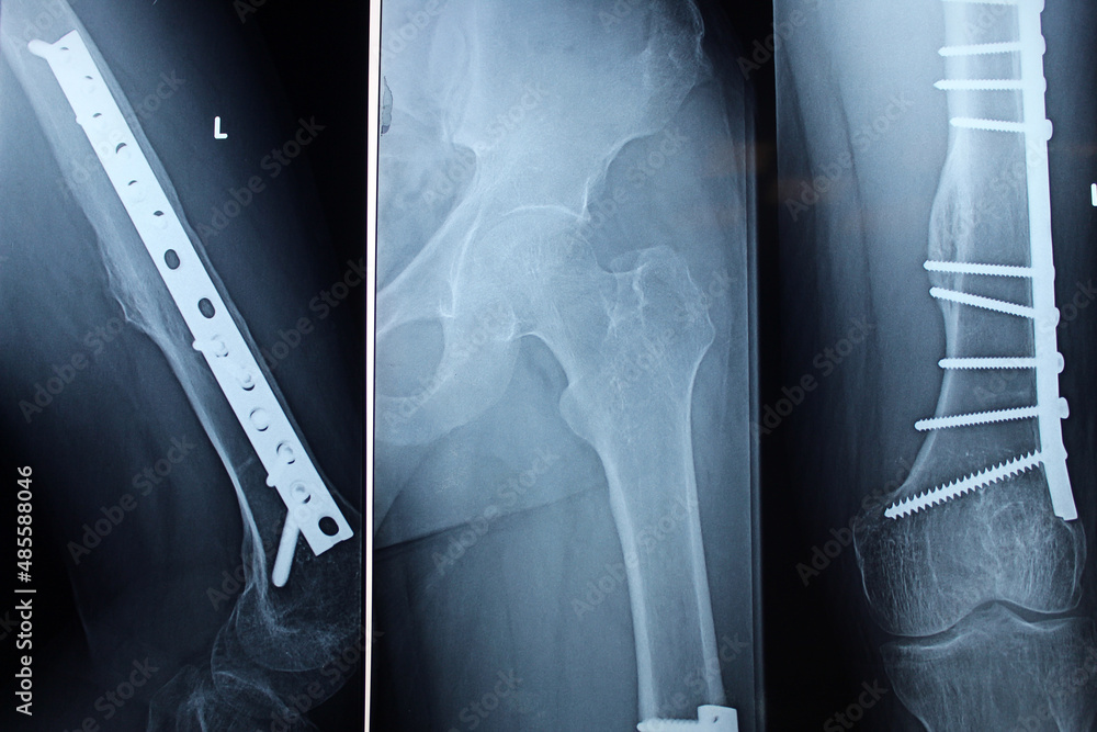Plain X ray on the left femur that shows united mid shaft left femur ...
