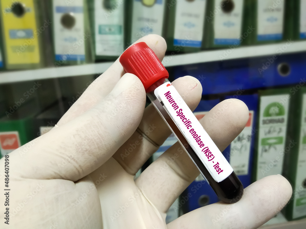 Blood sample for Neuron-specific Enolase or NSE Blood Test. To ...