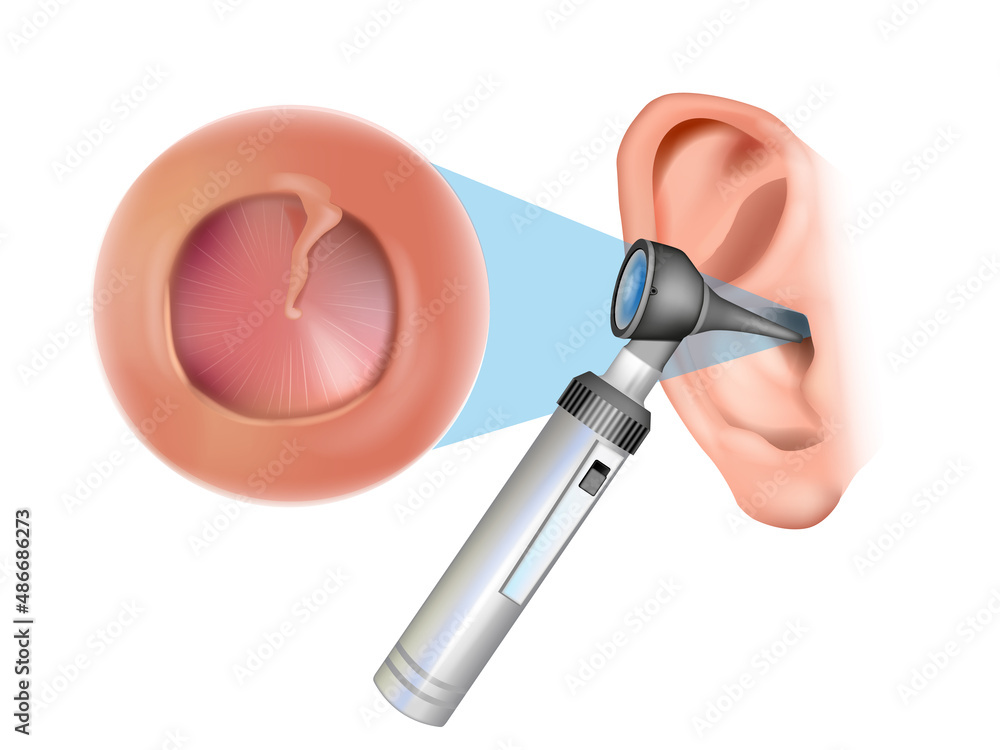 Ear examination with an otoscope. Otitis media with effusion: serous ...