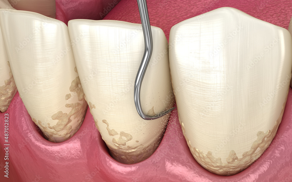 Oral hygiene: Scaling and root planing (conventional periodontal ...