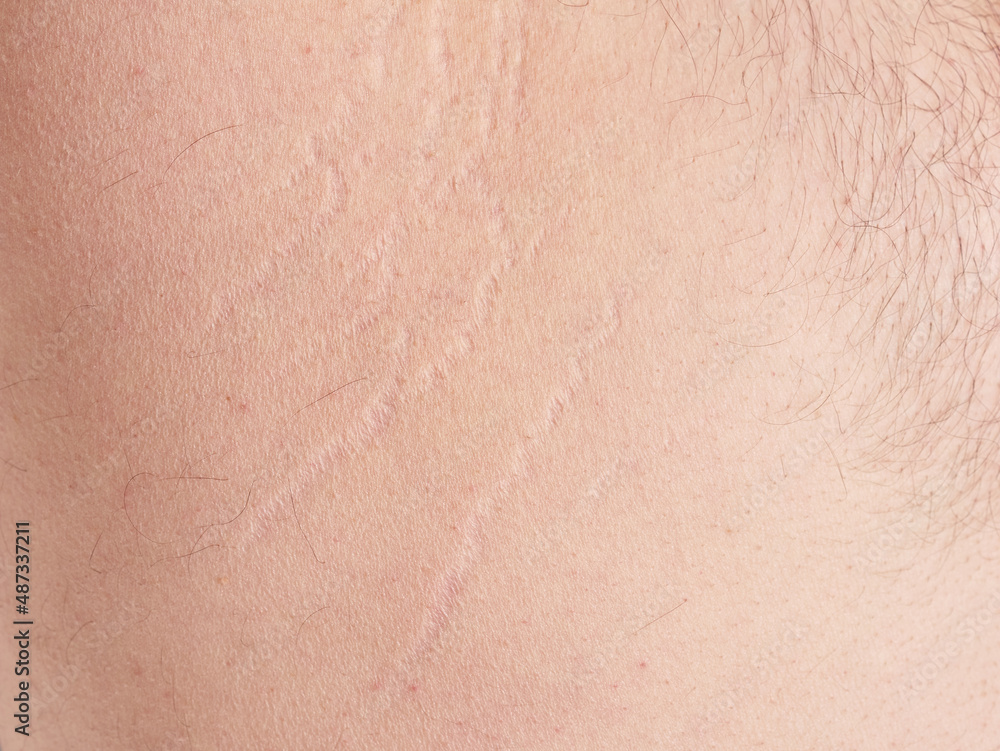 Stretch marks on the torso of a middle aged man, no faces shown, macro ...