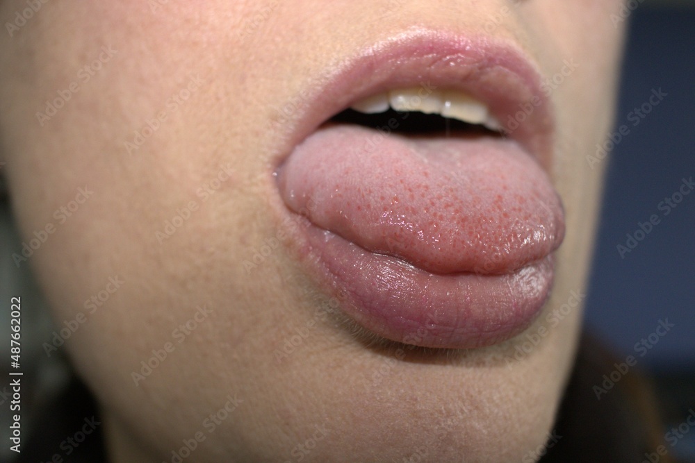 swollen enlarged white tongue with wavy ripple scalloped edges (medical ...