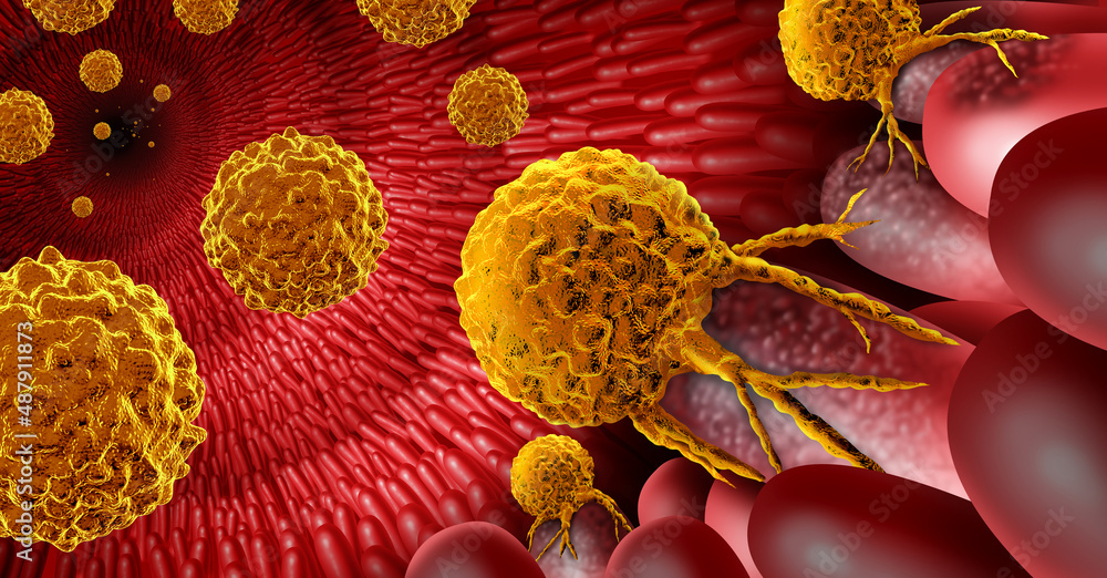 Inner intestine cancer anatomy concept as the malignant tumor growth ...
