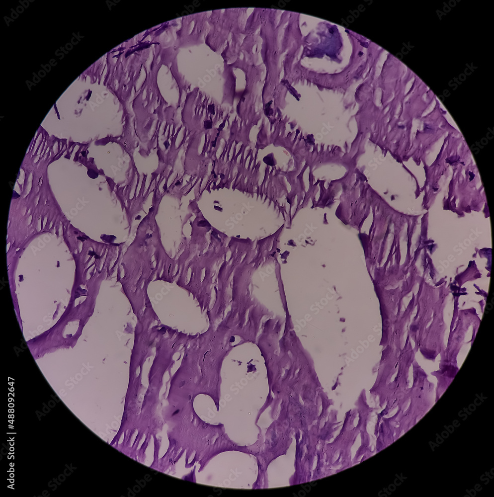 Calcinosis cutis(subcutis): microscopic view show fibrocollagenous ...
