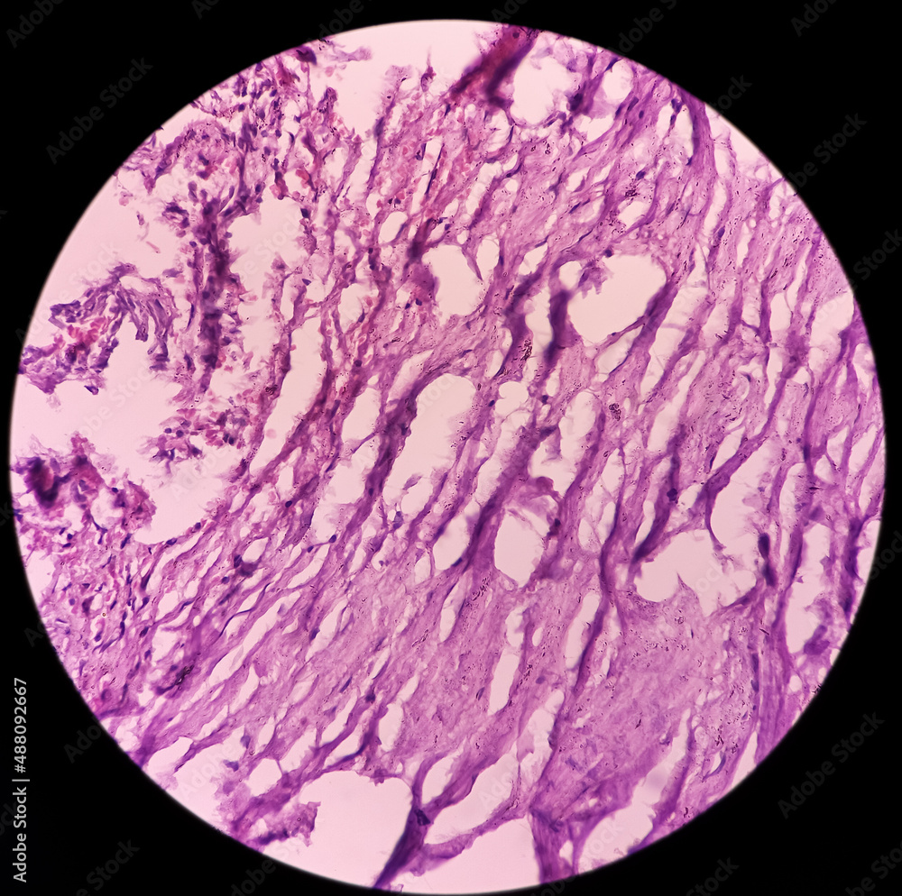 Calcinosis cutis(subcutis): microscopic view show fibrocollagenous ...