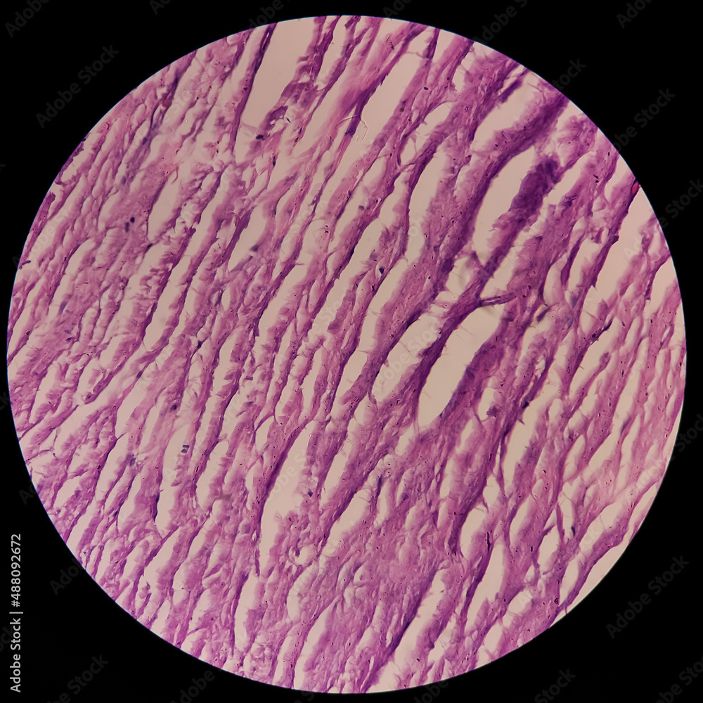 Calcinosis cutis(subcutis): microscopic view show fibrocollagenous ...