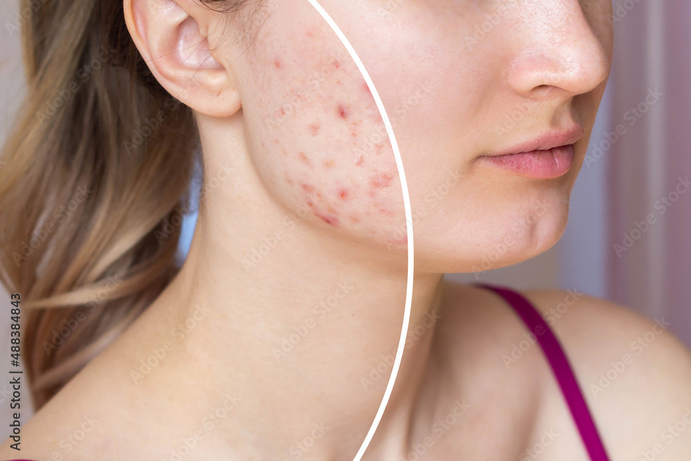 Cropped shot of a young woman's face before and after acne treatment ...
