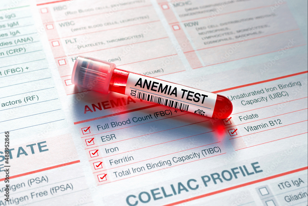 Blood sample for analysis of Anemia profile test in laboratory. Blood ...