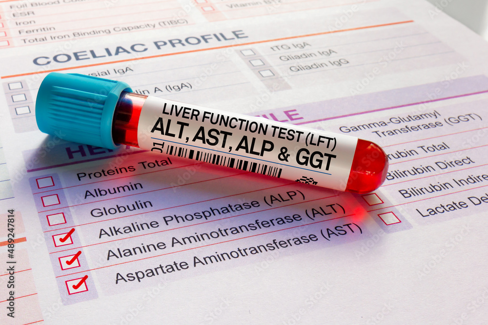 Blood sample tube for analysis of LFT Liver Function Tests ALT, AST ...