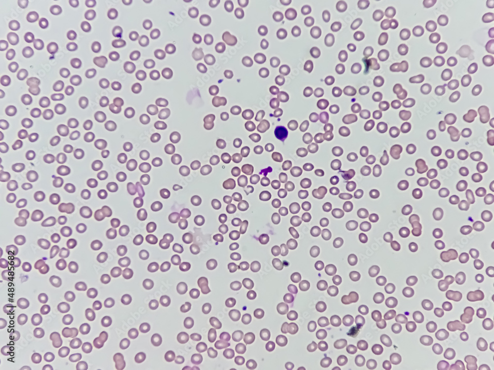 Hereditary hemolytic anemia. Hemoglobin E (HbE) disease, hypochromia ...