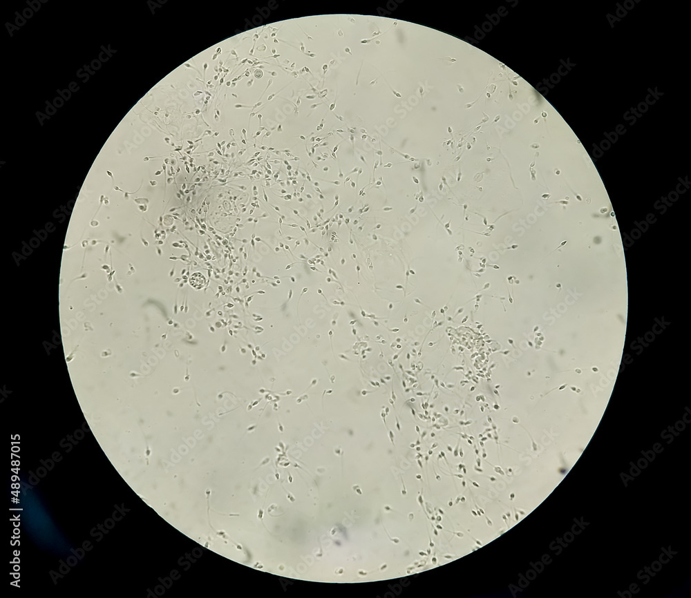 Normozoospermia analyzed by microscope. Semen analysis normal sperm and ...