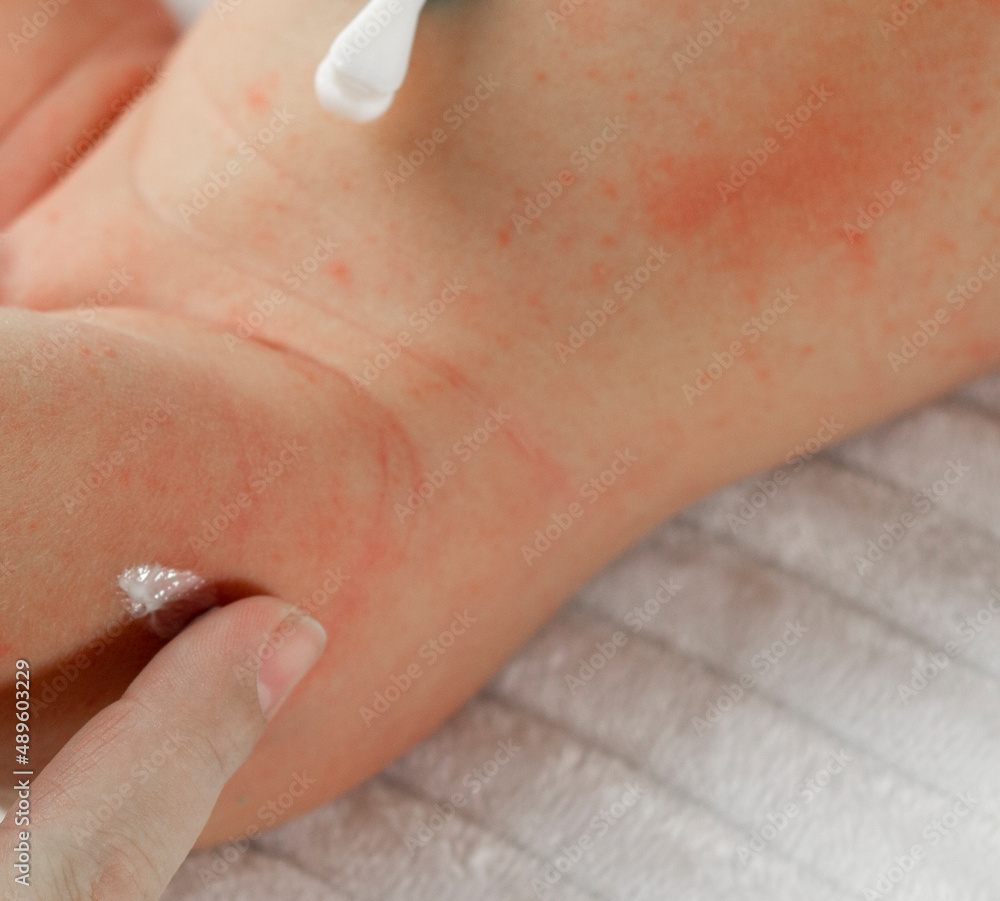 diaper rash in babies and care for them from the first days of birth ...