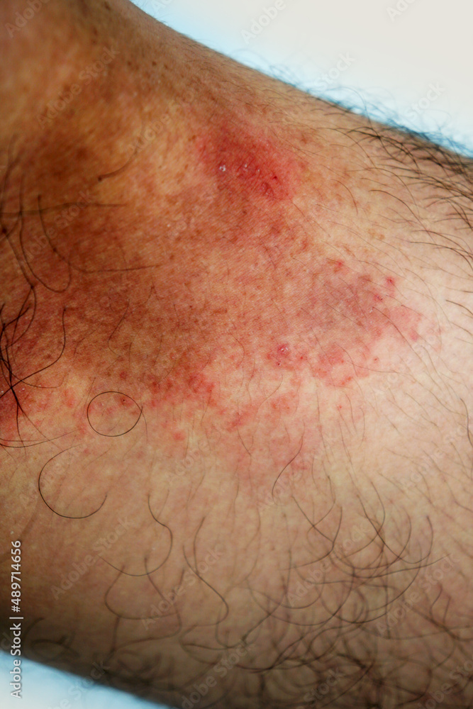 Itchy rash in the groin area. Tinea Cruris is a type of skin disease ...