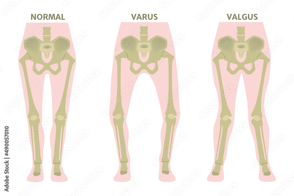 Valgus and varus leg deformities. Diagram showing the deformed bones of ...