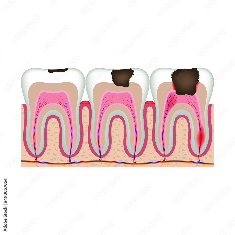 Vektor stages of caries. Stages of tooth destruction and pulp ...