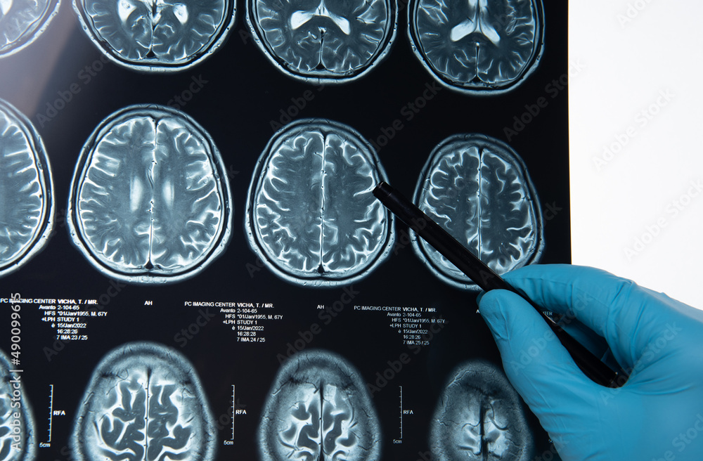 Foto de Stock Doctors reviewing brain x-rays;MRI of the blood vessels ...