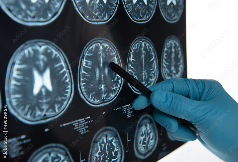 Stock-Foto „Doctors reviewing brain x-rays;MRI of the blood vessels in ...