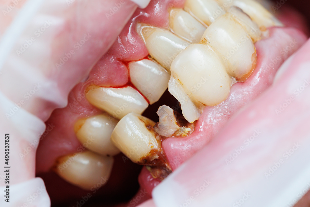 Spoiled teeth, poor dental hygiene, caries, Mouth disease. shattered ...